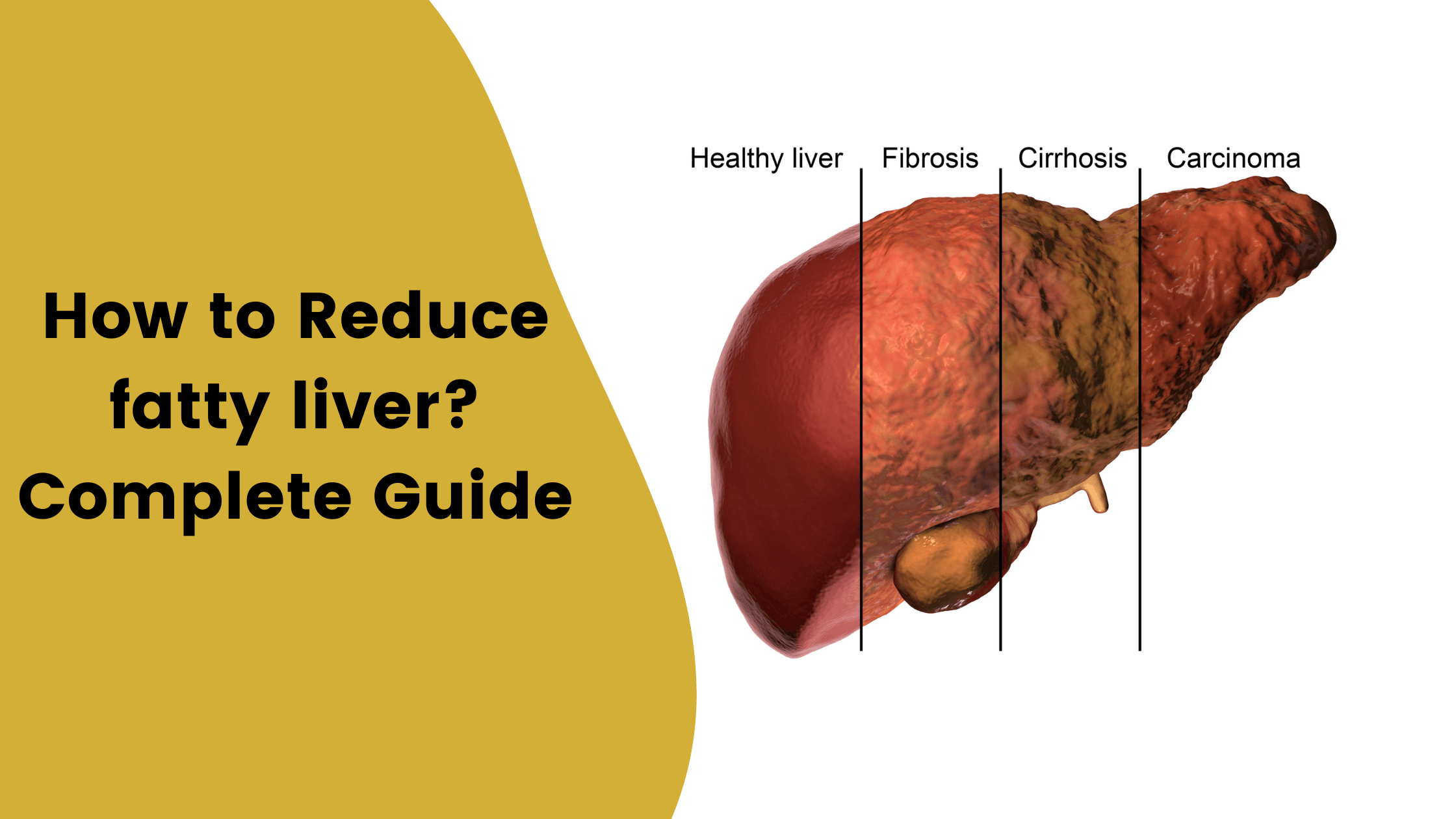 How to Reduce fatty liver? Complete Guide View