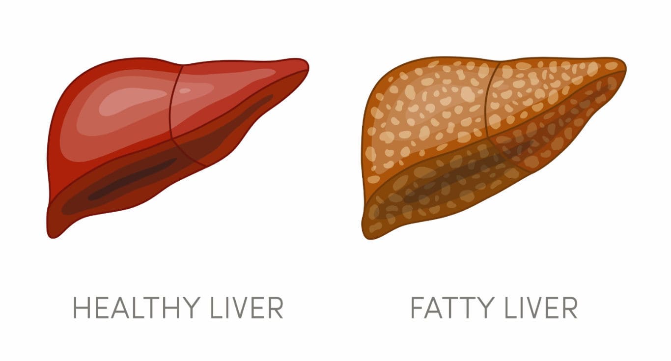 Fatty Liver: Everything You Need to Know